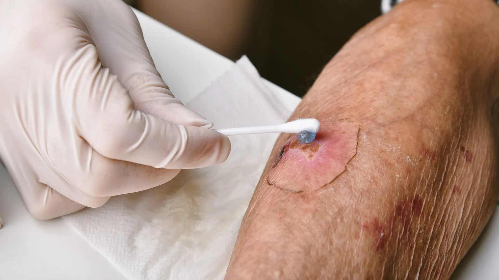 Tissue Viability for Senior Carers and Nurses - LFX Healthcare